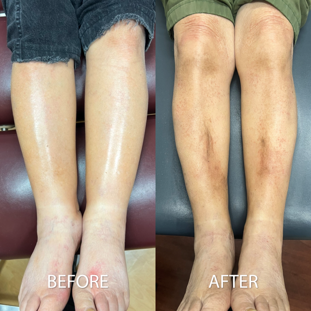 Lymphedema - Mid America Rehab